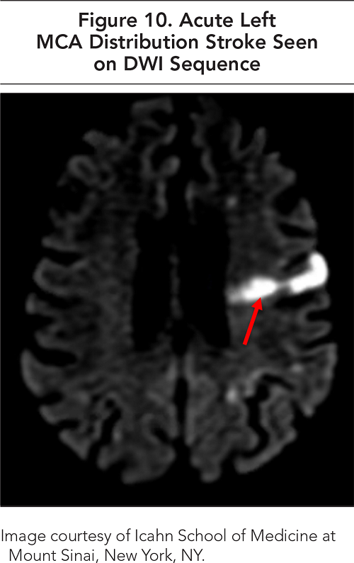 Acute Stroke Care - Current Topics