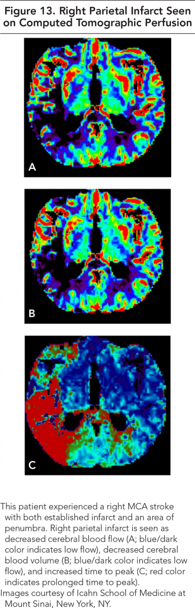 Acute Stroke Care - Current Topics