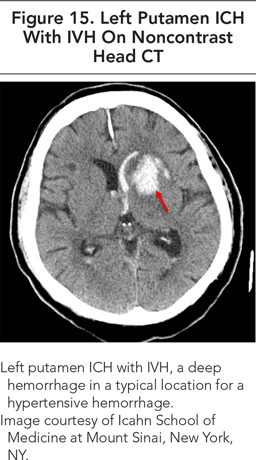 Acute Stroke Care - Current Topics
