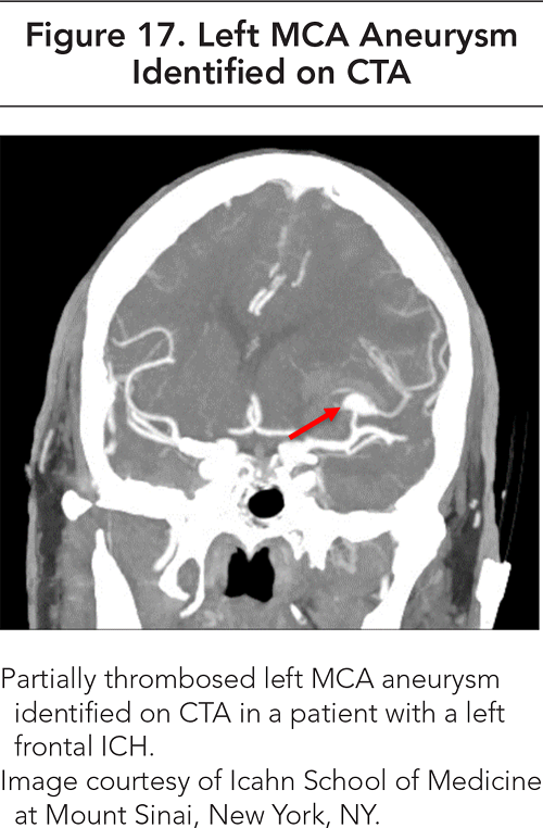 Acute Stroke Care - Current Topics