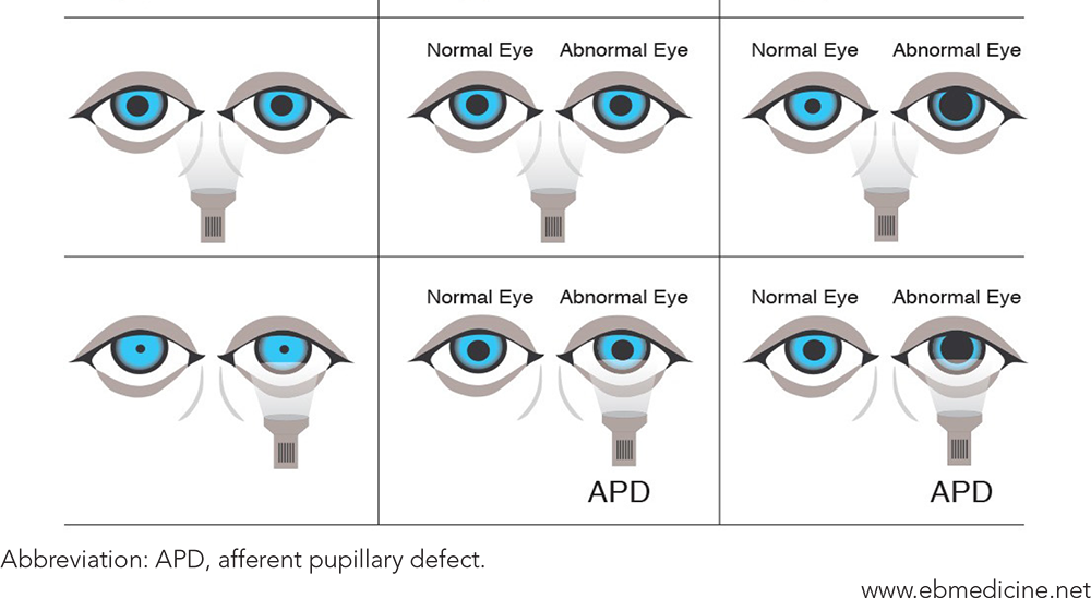 Acute Stroke Care - Current Topics