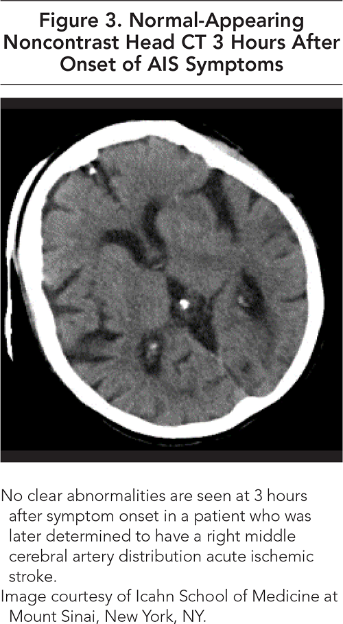 Acute Stroke Care - Current Topics