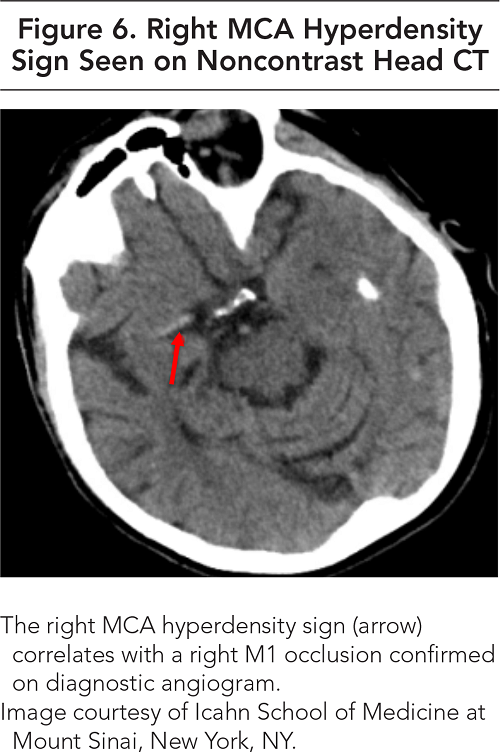 Acute Stroke Care - Current Topics