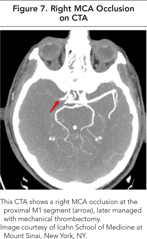 Acute Stroke Care - Current Topics