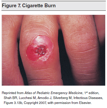 Tables and Figures: Skin Infections in Pediatric Patients