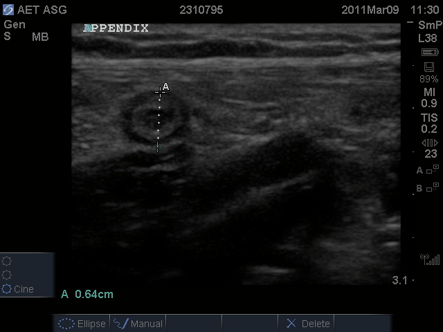 Appendicitis Ultrasound Criteria