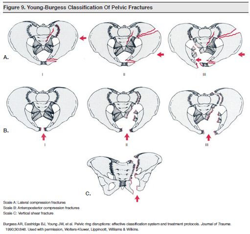 Lateral Compression Injuries Of The Pelvic Ring