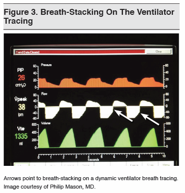 Clinical Pearls For Ventilator Management