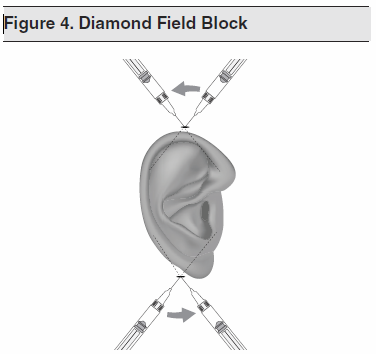 Upper Extremity Nerve Blocks