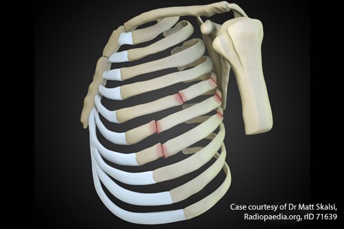 Rib Fractures: Diagnosis and Management in the Emergency Department