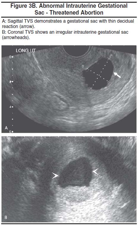 Gestational Sac Miscarriage