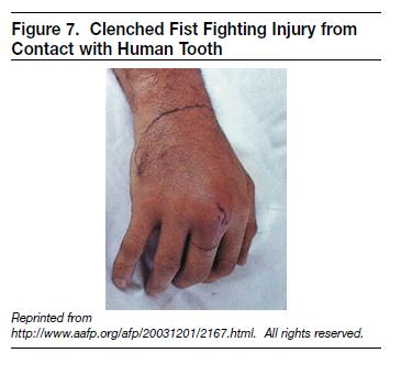 Immunocompromised Patients