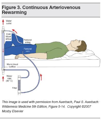Extracorporeal Rewarming