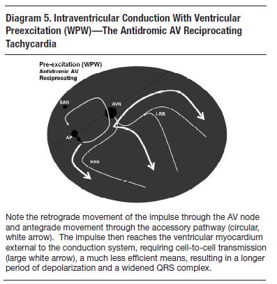 SVT With Aberrant Ventricular Conduction (AVC)