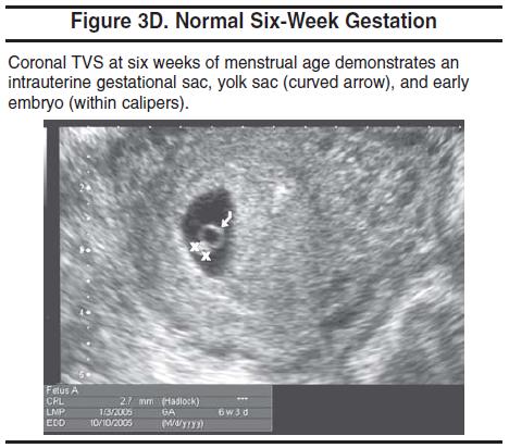 Use Of Ultrasound In Miscarriage