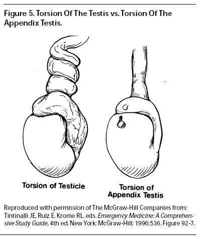 Case 6 Torsion Of Testicular Appendix