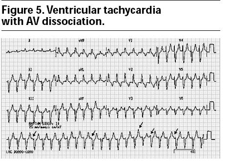 Pulseless Ventricular Tachycardia