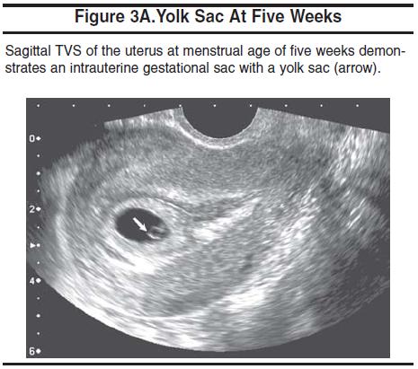 Use Of Ultrasound In Miscarriage